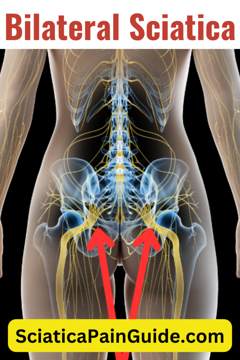 Bilateral Sciatica - Sciatica Pain Guide