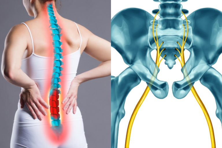 Sciatic Nerve Pain In The Hip - Sciatica Pain Guide