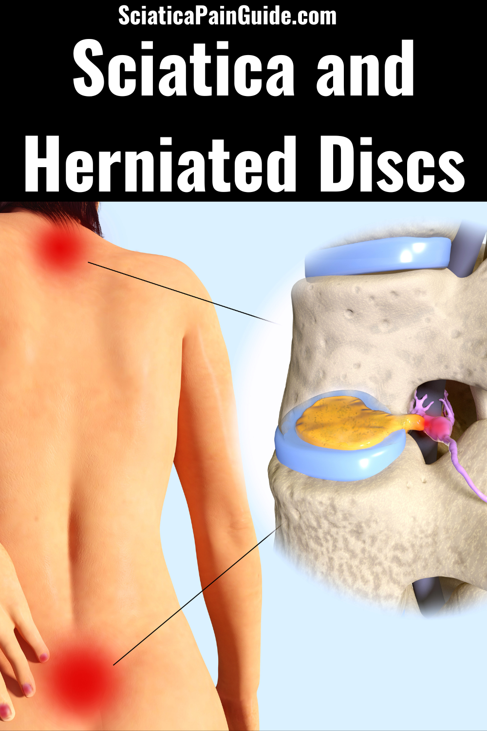 Sciatica and Herniated Discs - Sciatica Pain Guide